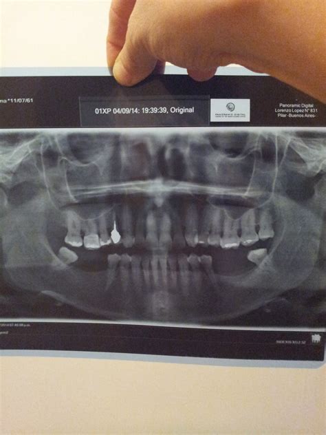 IMPLANTES DENTALES CASO CLÍNICO