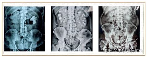 结石也分 门派”？成分不同，预防大不同！ 知乎