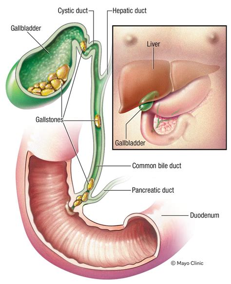 Common Bile Duct Stones