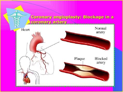 Nurserevieworg Angioplasty Vs Bypass