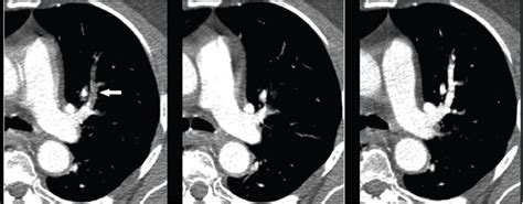 Cat Scan Image Artifacts