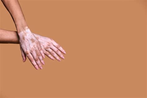 겨울이면 더 심해지는 ‘백반증 원인과 치료방법 헬스케어저널