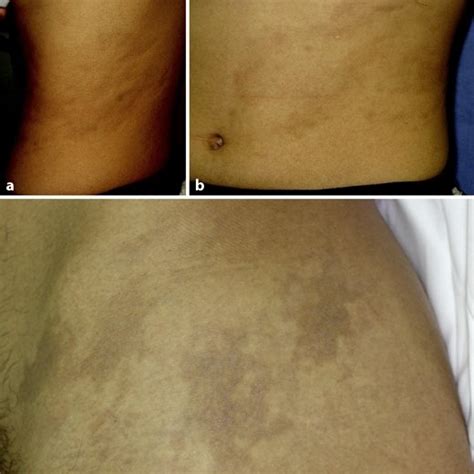 A B Asymptomatic Slate Gray Pigmented Plaques On The Left Thigh A