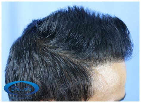 Dr Arvind Poswal Hair Transplant India 51 Hair Restoration News Worldwide
