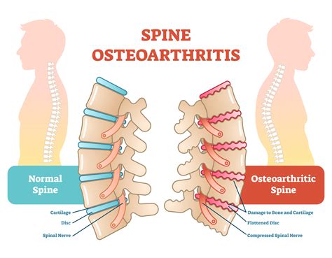 Spinal Osteoarthritis