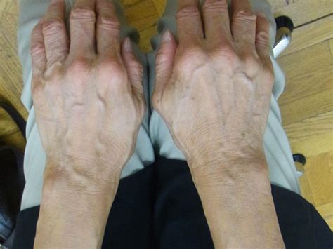 60代女性 両腕、両手甲と前腕の浮き立つ血管を目立たなくした治療例 ハンドベイン治療サイト｜北青山dクリニック