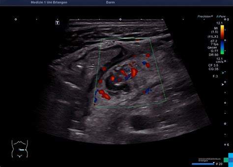 Diverticulitis Atlas Of Ultrasound