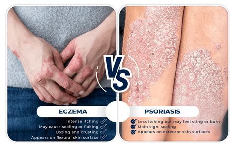 Eczema And Psoriasis Ko Skin Specialist