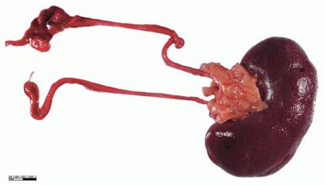 Pathology Of The Renal Pelvis And Ureter Abdominal Key
