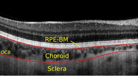 Sample Oct Image With Choroidal Layer Boundaries Marked In Red