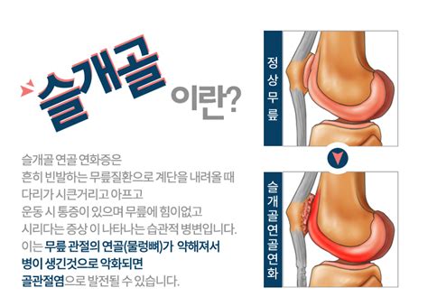 무릎 통증 무릎 시림 젊은 사람도 많습니다 슬개골 연골 연화증의 원인 진단 치료 [ 순천 여수 광양 무릎 통증 슬개골 연골 연화증 포바즈 다우 한의원 ] 네이버 블로그