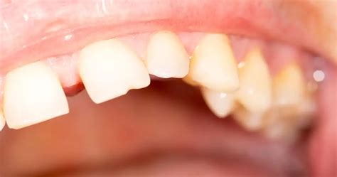 How To Get Rid Of Gaps In Teeth Diastema Options And Costs