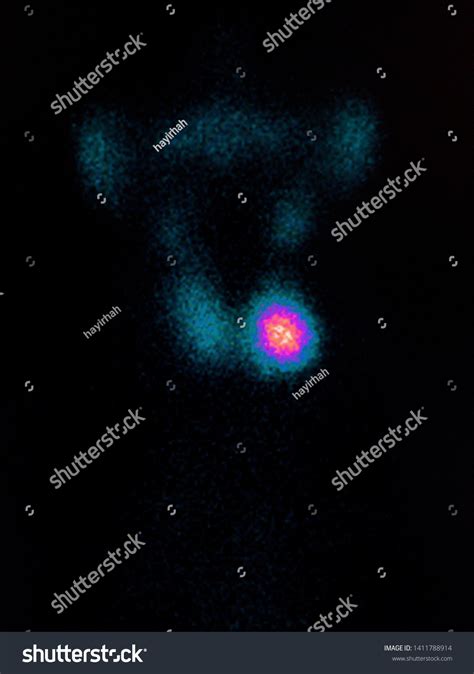 This Hot Nodule That Filled Whole Stock Illustration Shutterstock