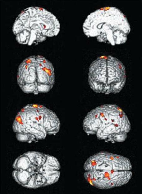 Regions Of Relative Accelerated Loss Of Grey Matter Volume In Dm1