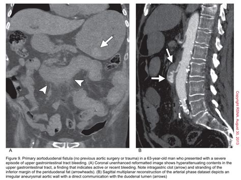 The Critical Gastrointestinal Hemorrhage Evidence Based Management