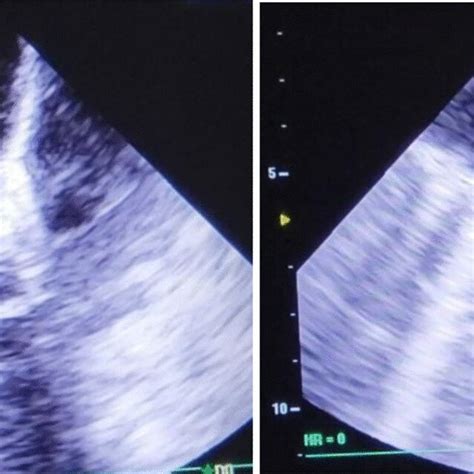 Before The Management Of Bacterial Pneumonia Chest Radiography Shows