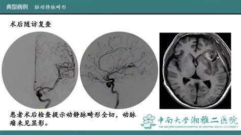 蒋宇钢教授：颅内复杂巨大动静脉畸形的显微外科治疗策略 脑医汇
