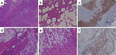 Figure1 Histopathological Findings Of The Two Cases Of Colorectal Download Scientific Diagram