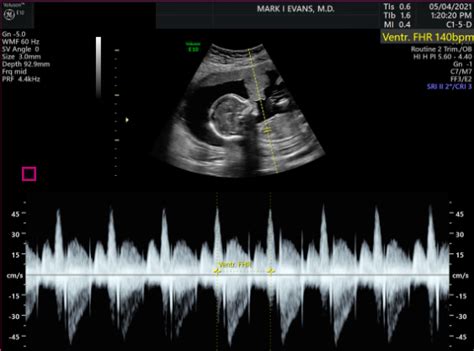 Abnormal Ultrasound 11 Weeks