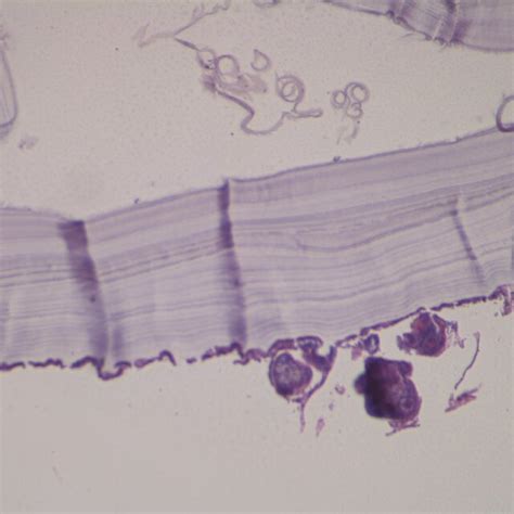 Macroscopic Examination Of A Cerebral Hydatid Cyst Showing A