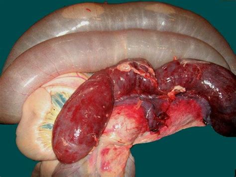 Nine Hours Strangulation Obstruction A Strangulated Part B Proximal