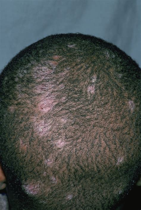 Ringworm Rash Scalp
