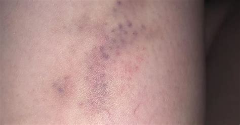 Bruising From Bites Album On Imgur