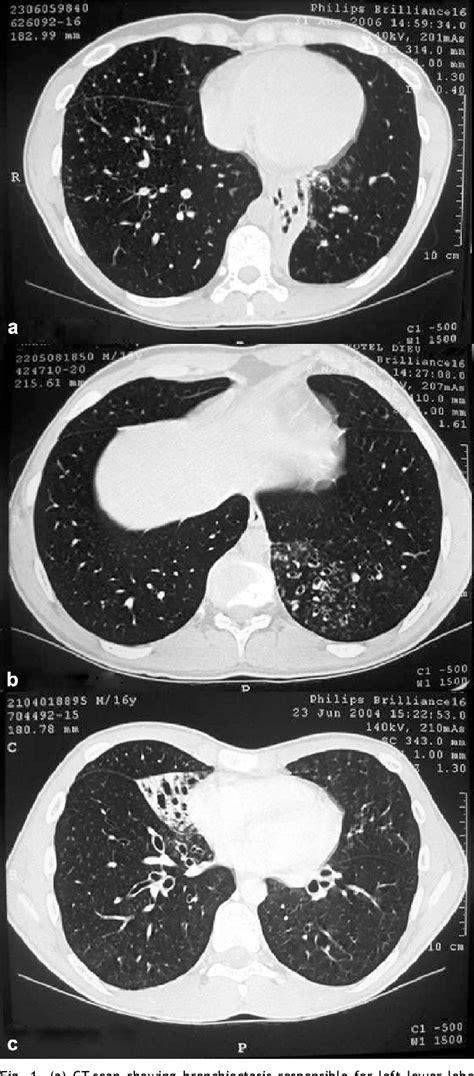 Figure 1 From Surgical Treatment Of Bronchiectasis Early And Long Term