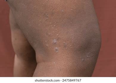 Hives On Black Skin