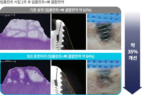 특수표면처리 임플란트