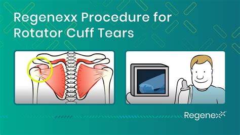 Regenexx Procedures For Shoulder Injuries And Arthritis Stemcell Arts