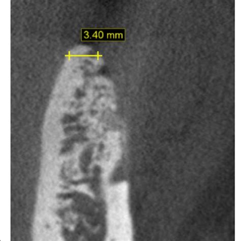 Baseline Cbct Demonstrating Horizontal Ridge Deficiency Download