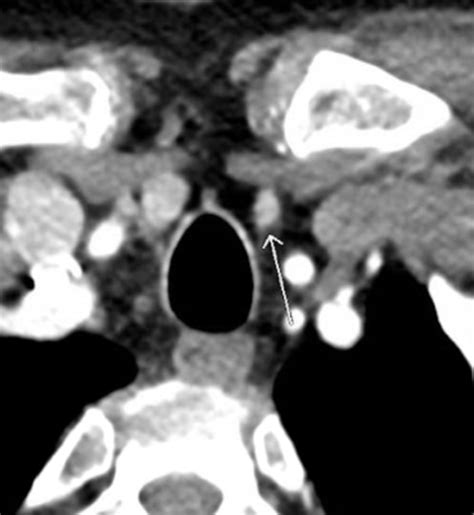 Minimally Invasive Parathyroidectomy Under Local Cervical Block Anesthesia For Primary