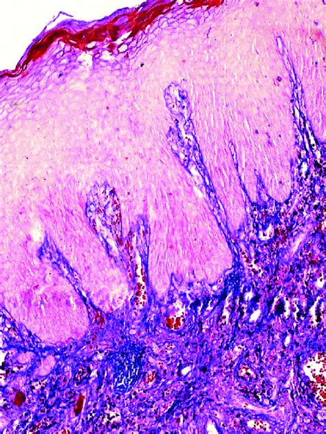 Hyperkeratinization Of The Surface Layer Of The Epithelium Keratin Is Download Scientific