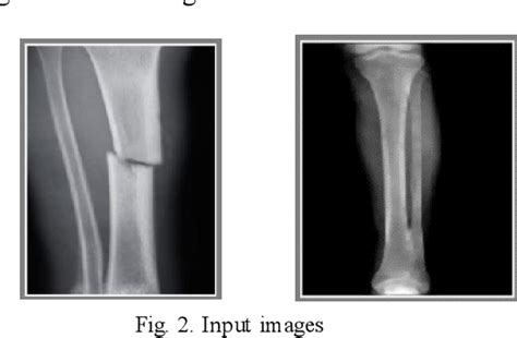 Figure From Image Processing For Detecting Bone Fractures Semantic Scholar