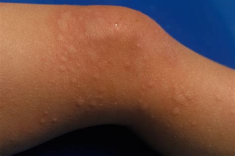 Itchy Red Bumps On Skin Not Hives Printable Templates Free