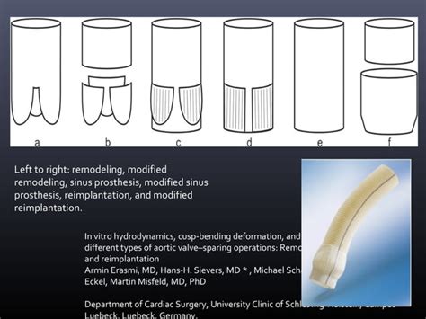 Aortic Valve Sparring Root Replacement David Vs Yacoub Ppt