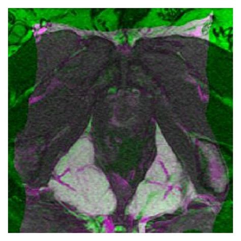 Registration Results Of Affine Ffd And Demons For Two Clinical Download Scientific Diagram