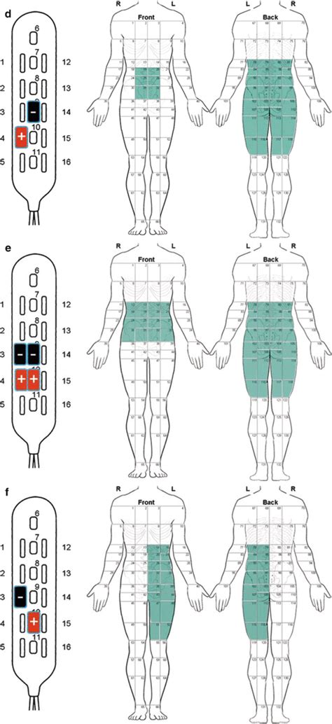 Programming Spinal Cord Stimulation Systems Anesthesia Key