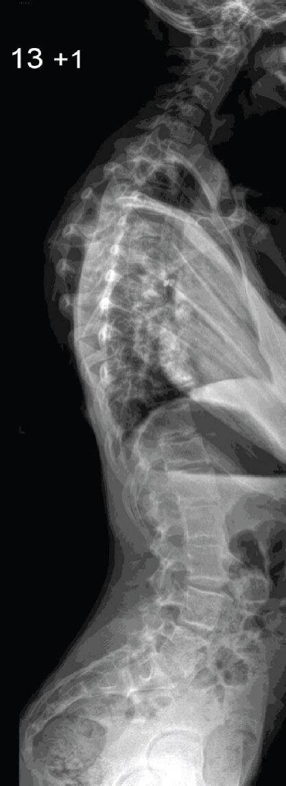 Preoperative Posteroanterior A And Lateral B Radiographs Of The