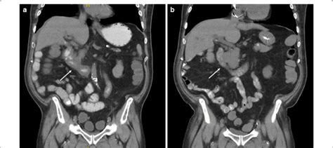 A Ct Abdomen Pelvis On Initial Presentation With Enteritis And Lack Of Download Scientific