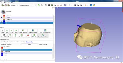 应用3d Slicer设计脑出血3d手术穿刺导板（续） 脑医汇