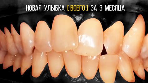 3 месяца [ВСЕГО‼️] на брекетах, и совершенно новая улыбка - YouTube