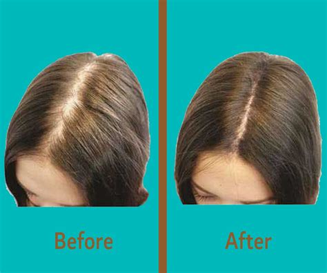 Paramedical Course Scalp Stretch Mark Vitiligo Scar Burn