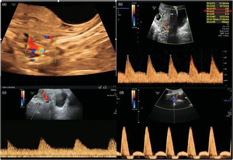 Color And Spectral Doppler Images Showing A The Uterine Artery