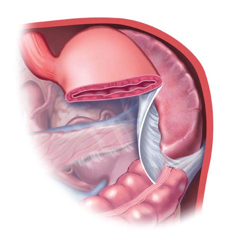 Laparoscopic Spleen Removal Splenectomy Patient Information From Sages
