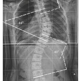 Cobb Angle Measurement Method Download Scientific Diagram