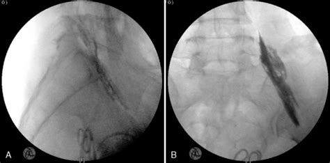 Transforaminal Epidural Block And Selective Nerve Root Block Neupsy Key
