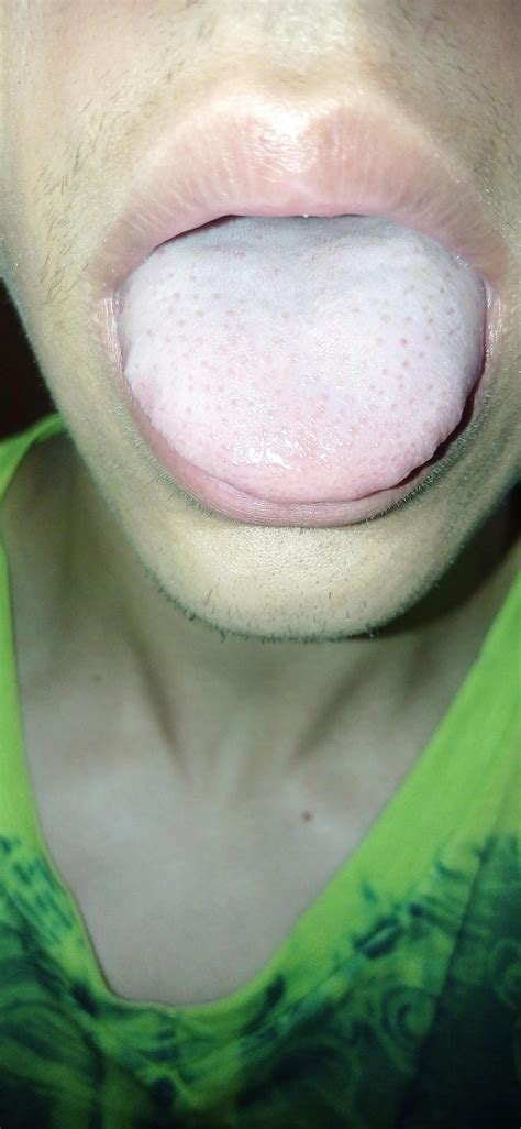 Is This Papillitis R Askdentists