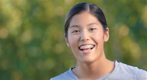 Damon Clear Braces Clear Braces Foothill Foothill Invisalign